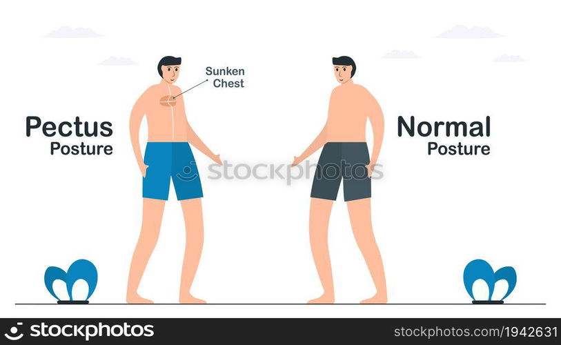 Comparison of normal and pectus posture. Pectus excavatum has a sunken ...