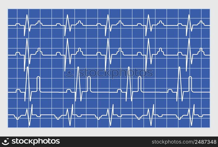 Electrocardiogram Scan Result Vector Concept Ekg Monitor For Emergency