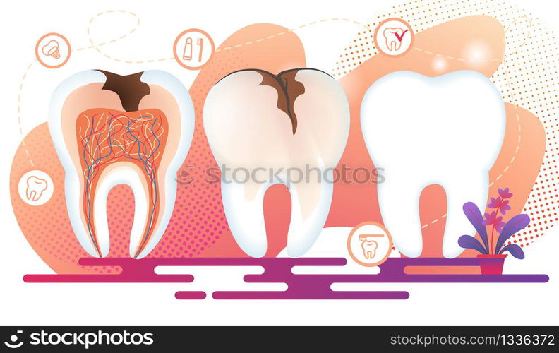 Healthy and Unhealthy Teeth Stand in Raw. Tooth Decay Cross Section ...