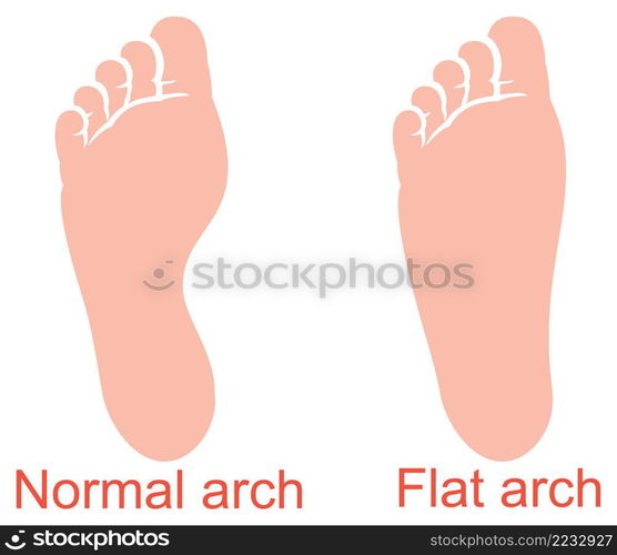 Human anatomy - flat and normal arch vector illustration — Stockphotos.com