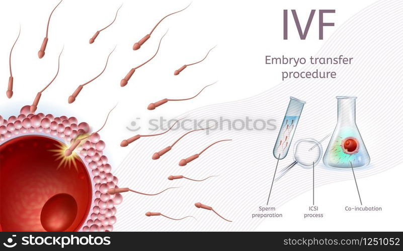 In Vitro Fertilization Embryo Transfer Procedure. IVF Process Chart ...