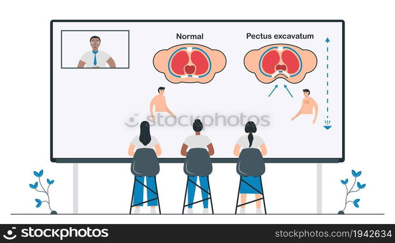 Students study about Pectus excavatum that is a structural deformity of ...